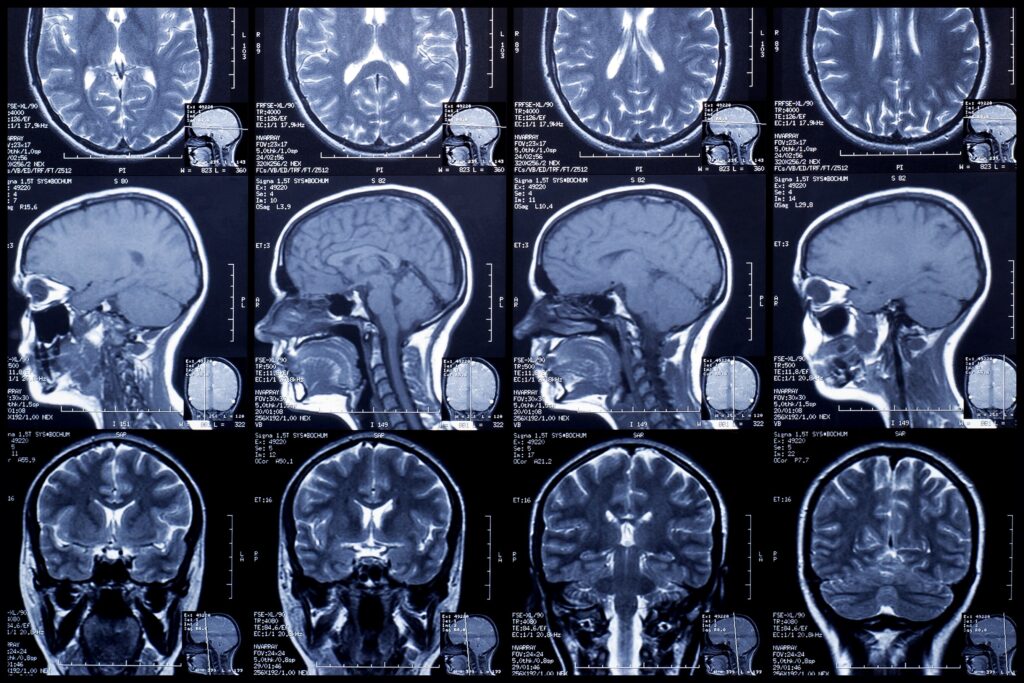 Abu Dhabi hospital reveals new brain scan to detect Alzheimer's earlier ...